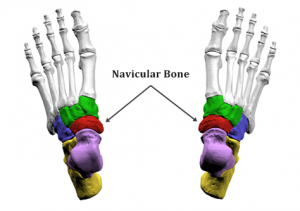 Painful Bump on Inside of Foot: The Accessory Navicular Bone | Trigger ...
