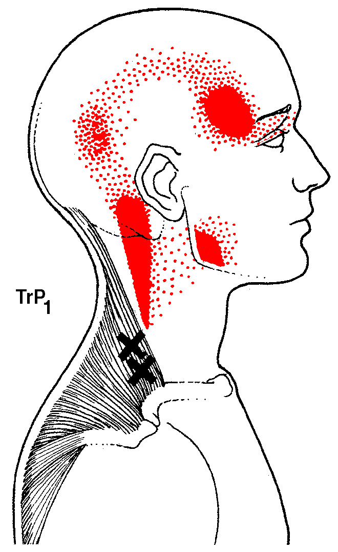 Trapezius Trigger Points And Referred Pain Pattern Trigger Point Self
