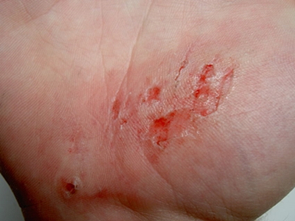 What is an Abrasion? – triggerpointselfhelp.com